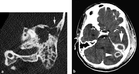 Cranial Epidural Abscess And Subdural Empyema Neupsy Key