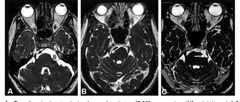 Figure 1 From Imaging Of Vascular Causes Of Trigeminal Neuralgia Semantic Scholar