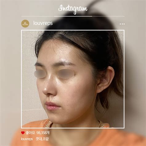 루브르성형외과 처음처럼 자연스럽게 전후사진후기셀카후기