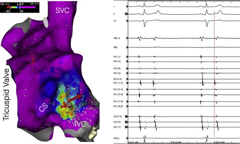 activation map and electrograms download scientific diagram