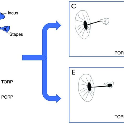 Simplified Schematic Drawing Of Several Situations When Ossicular