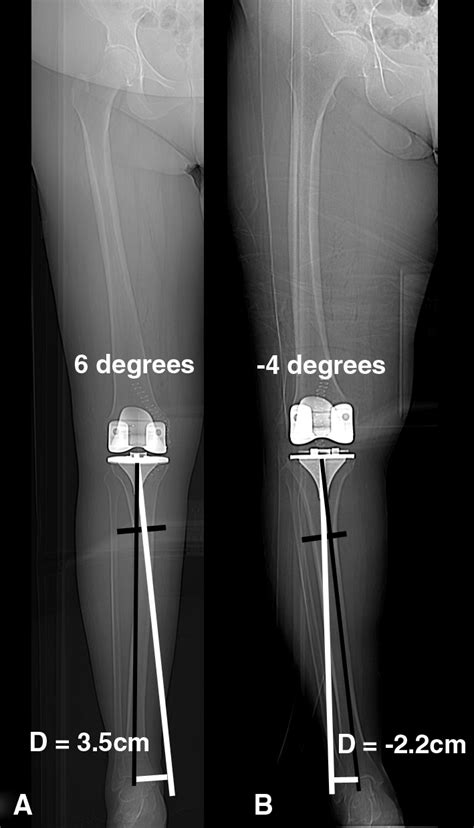 The Anatomic Axis Of The Tibia Longitudinal White Line Was A Line