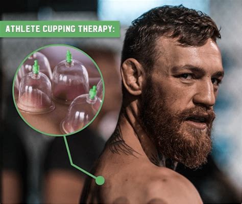 What Is Cupping Therapy And What Are The Benefits Glasgow Premier