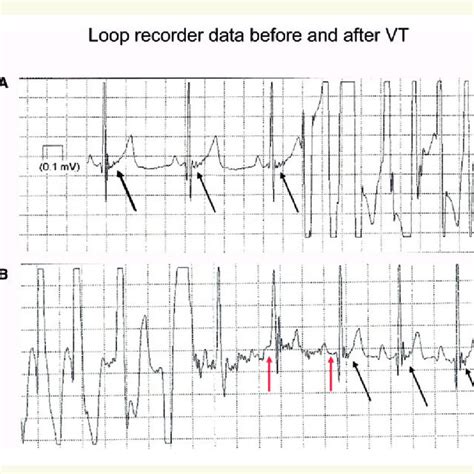 PDF Epsilon Wave On An Electronic Loop In A Case Of Arrhythmogenic Right Ventricular Dysplasia