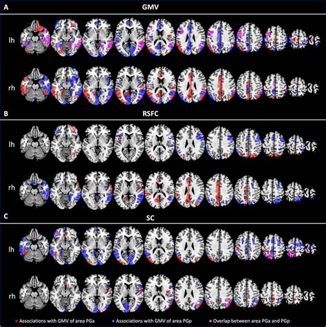 Brain Regions Being Significantly Associated With Gmv Of The Ag