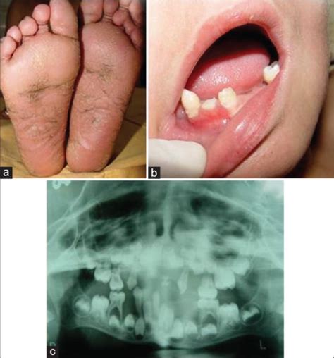 Hereditary Palmoplantar Keratoderma A Practical Approach To The Diagnosis Pmc