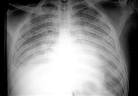 Chest Radiograph Showing Bilateral Diffuse Download Scientific Diagram