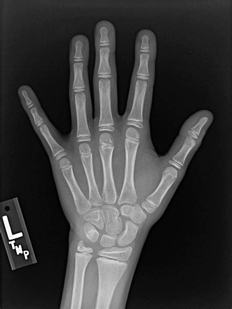 How To Remove White Borders Around X Ray Image With Opencv Python