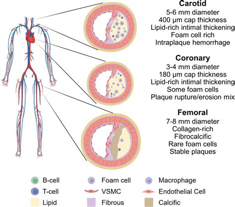 Manifestations Of Human Atherosclerosis Across Vascular Beds Jvs