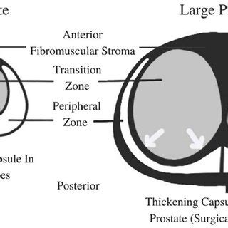 Schematic Diagrams Of A Transverse View Of The Mid Prostate Arrows