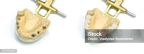 치과 임플란트 및 정형 외과 임플란트 구조와 턱 모델 임플란트 보철 개념 정형 외과 치과 흰색 배경에 격리됩니다 세라믹