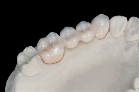 Fully Monolithic Zirconia Fmz Scd