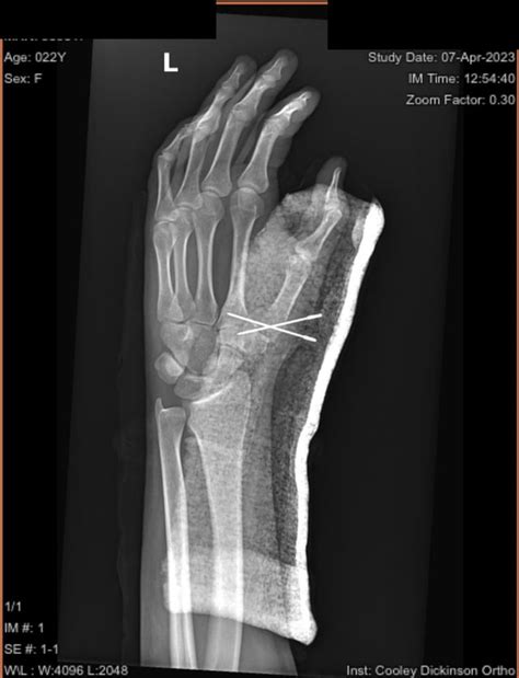 My Tiny First Metacarpal Break That I M Still Feeling Today Don T Fall