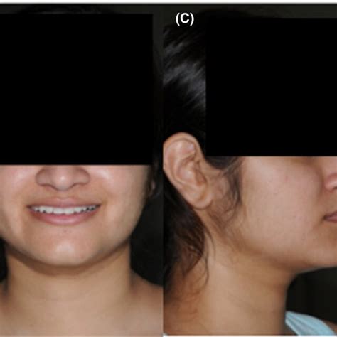 A Incisors Of Class I Ii Skeletal Patients Showing The Buccal First Download Scientific