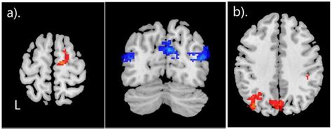 A Increased Alff In The Contralesional Somatomotor Network And