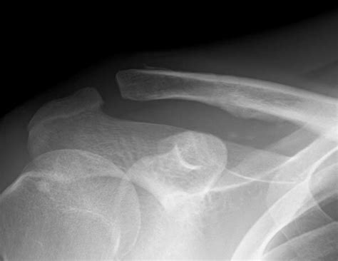C Although Calcification Of The Repaired Ligament Was Observed