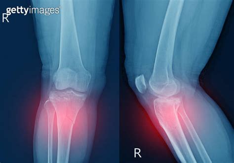 X Ray Knee Fracture Proximal Metaphysis Of Tibia Depressed Fracture Of Lateral Tibial Plateau