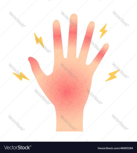 Dry And Rough Hands Chapped Hands Royalty Free Vector Image