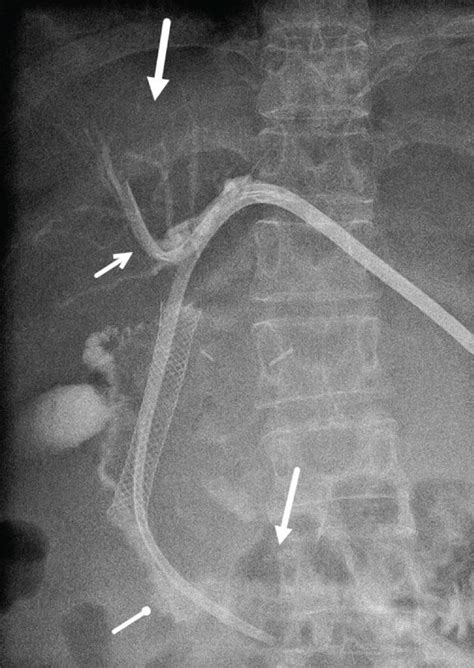 Contrast Cholangiogram Via Dual Split Lumen Catheter The Efferent