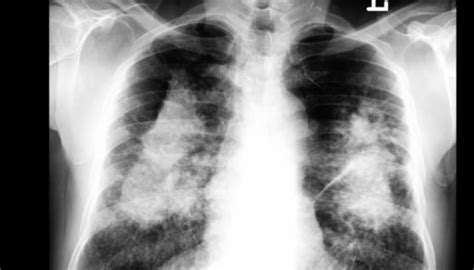 Online Registration Open For Silicosis Tb Ex Mine Workers To Claim Compensation