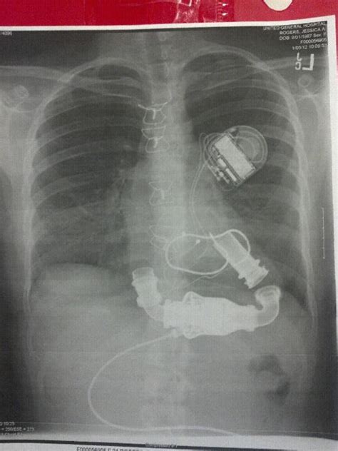 Best Images About LVAD Info On Pinterest Implantable Cardioverter Defibrillator Charts And