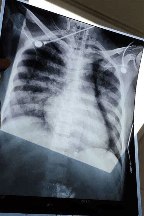 Antero Posterior Chest X Ray Showing Bilateral Diffuse Reticular Download Scientific Diagram