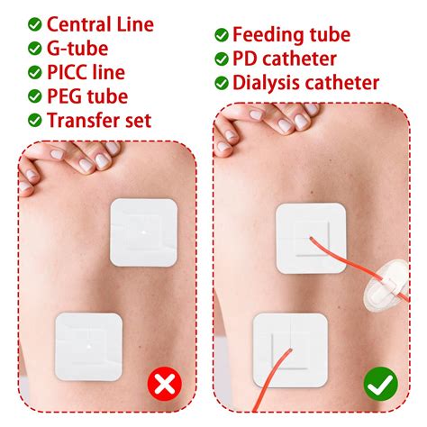 15 Pcs Split Drain Adhesive Feeding Tube Bandages Peg G