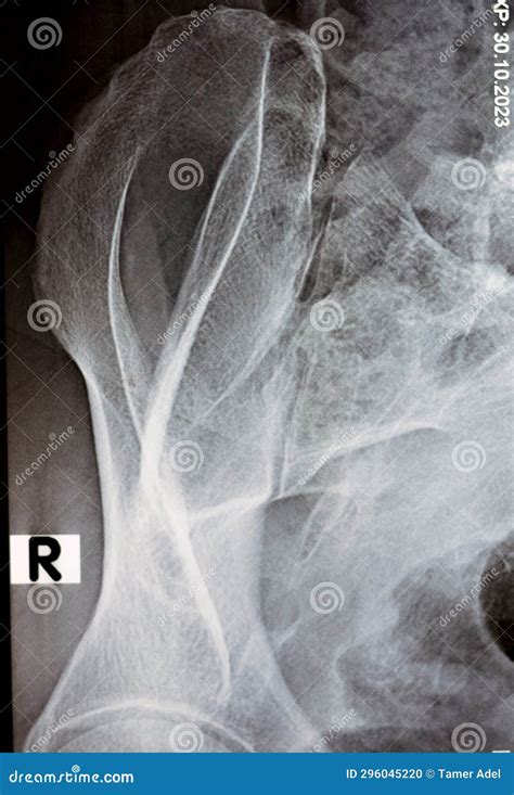 Sacroiliac Joint Digital Radiograph Examination X Ray Reveals Preserved
