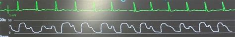 Non Intubated Patient Etco2 Waveform With A Notch At The End R Ems