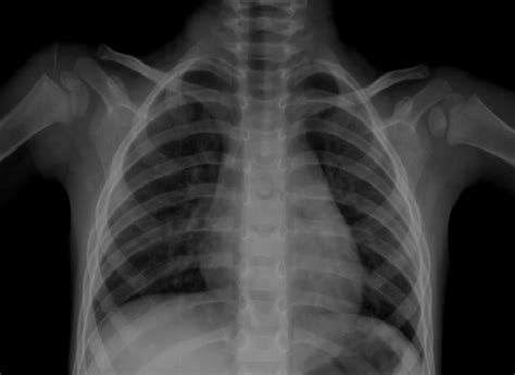 Figure 5 From Ewing Sarcoma With Unusual Skull Metastasis In A Four Year Old Semantic Scholar