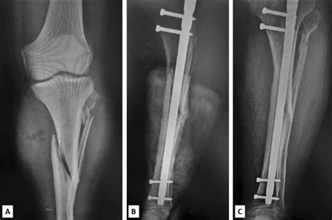 A Proximal Tibia Fracture Fixed By Imn A Before Surgery B Immediate A Proximal Tibia Fracture Fixed By Imn A Before Surgery B Immediate