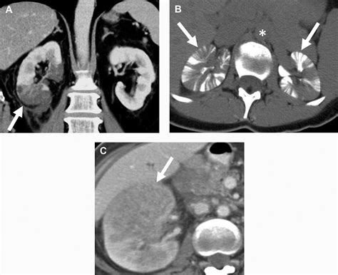 Imaging Of Renal Infections And Inflammatory Disease Radiologic Clinics