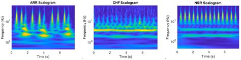 Deep Learning Based Arrhythmia Detection Using Ecg Signals A