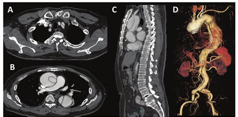 Aortic Dissection Stanford Classification Type A A And B Axial Plane Download Scientific