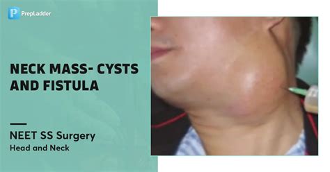 Neck Mass Cysts And Fistula