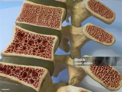 골다공증의 다양 한 단계를 보여주는 척추의 단면의 해부학 적 모델 및 척추 체 뼈모세포에 대한 스톡 사진 및 기타 이미지 뼈모세포 골다공증 건강 진단 Istock