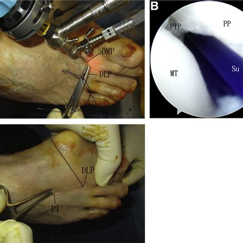 Plantar Plate Tenodesis And Release Of Collateral Ligaments For