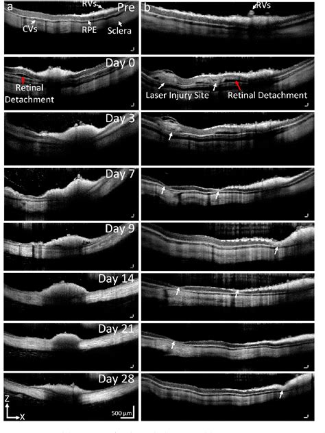 Figure 3 From Multimodal In Vivo Imaging Of Retinal And Choroidal Vascular Occlusion Semantic