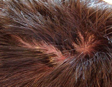 Foliculitis Decalvante Claudia Bernárdez Dermatóloga En Madrid