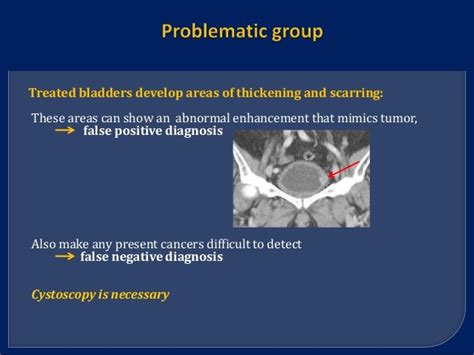 Role Of Ct Urography In Bladder Cancer Cambridge Lecture