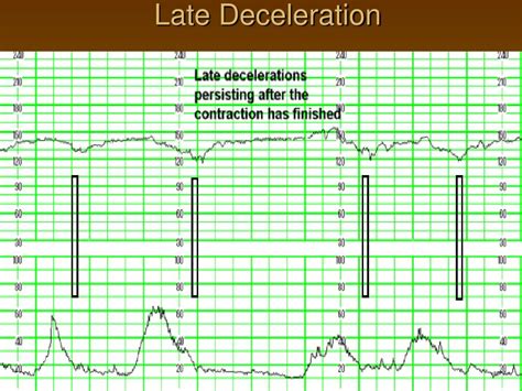 Ppt Electronic Fetal Monitoring Powerpoint Presentation Free