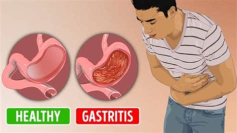 Be Aware Of Chronic Gastritis The New Times
