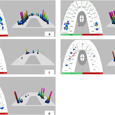 Occlusal Force Distribution Before And 1 Year After Surgery Using Download Scientific Diagram