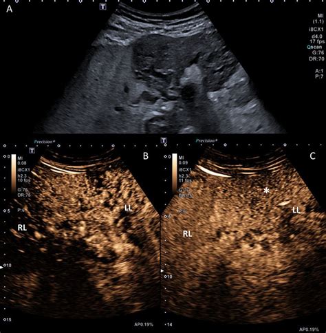 Ultrasound With B Mode Indicating A Diffusely Altered Echogenicity Of Download Scientific