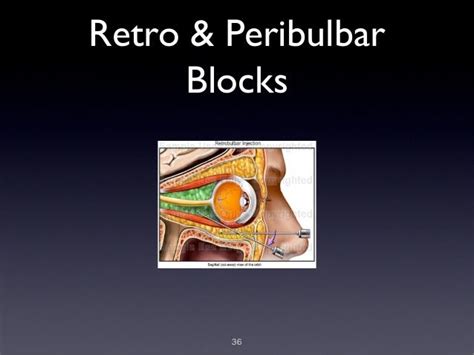 Anaesthesia For Ophthalmic Surgery Anaesthesia For Ophthalmic Surgery