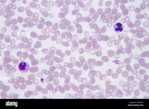 Plasmodium Under Microscope 400x A Clinicopathological Analysis Of