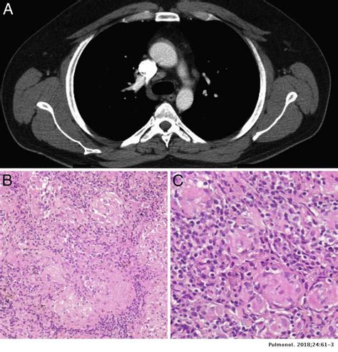 Mediastinal Sarcoid Like Reaction In Cancer Patients Pulmonology