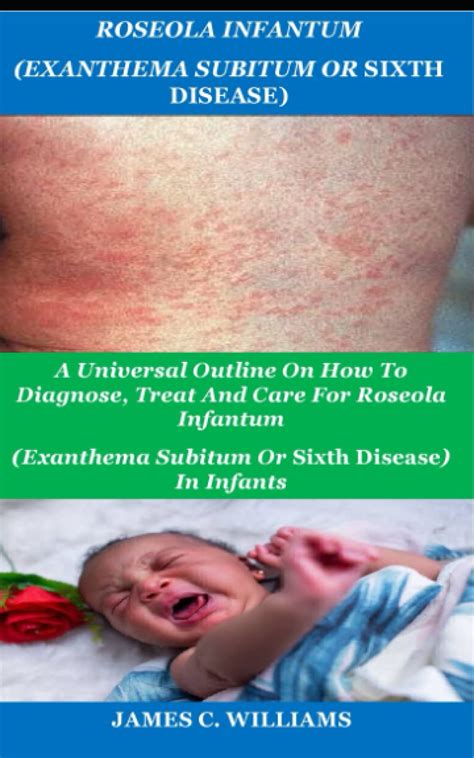 Buy Roseola Infantum Exanthema Subitum Or Sixth Disease A Universal Outline On How To