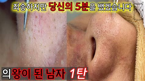 피지 직접 뽑아드렸습니다 피지제거 블랙헤드제거 피지뽑기 경기도 의왕에 사는 30대 피지왕이 되고싶은 그 남자 피지제거 1탄 Youtube
