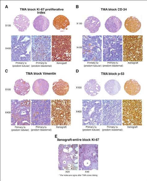 Immunostaining Of Wish Wt Tissue Microarray Tma Of Wish Wt